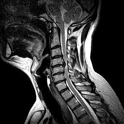 Cervical Spine MRI Report Without Contrast